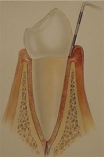 Parodontitis | Dortmund | Dr. Nina Eckardt & Dr. Mathias Gläser