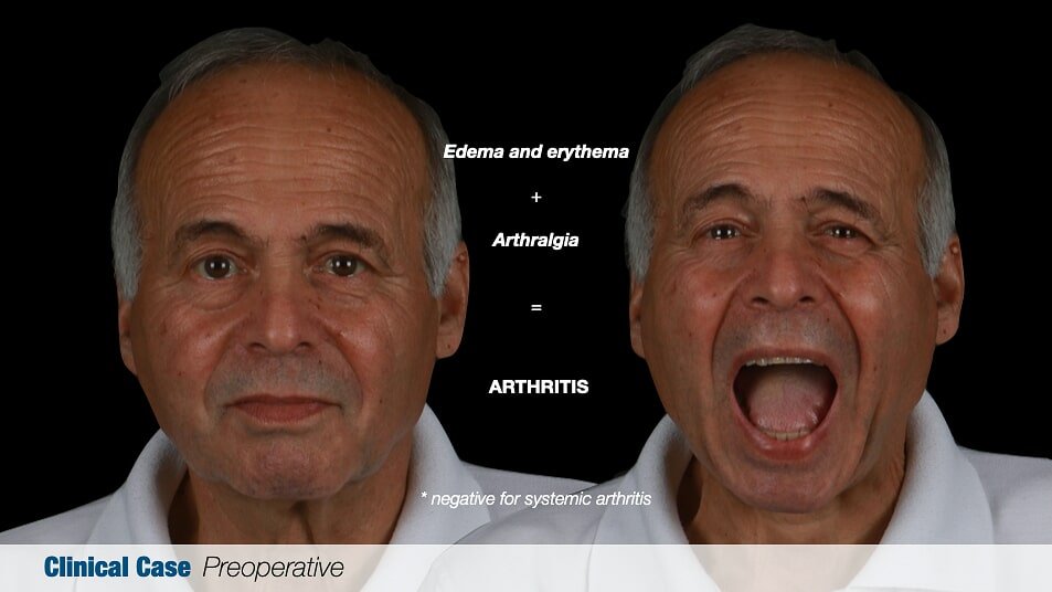 UM CASO RARO DE ARTRITE SÉPTICA DA ARTICULAÇÃO TEMPOROMANDIBULAR