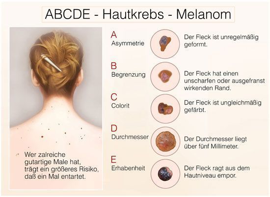 Tumore Abklärungen | Richterswil | Hautarztpraxis Rawa Derzi