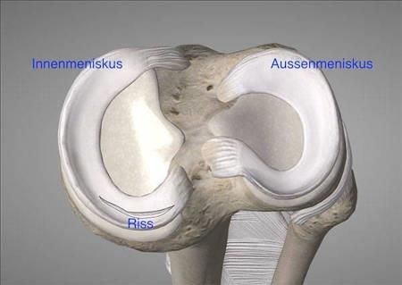 Meniskusriss konservativ behandeln | Orthopädie Rheinauhafen