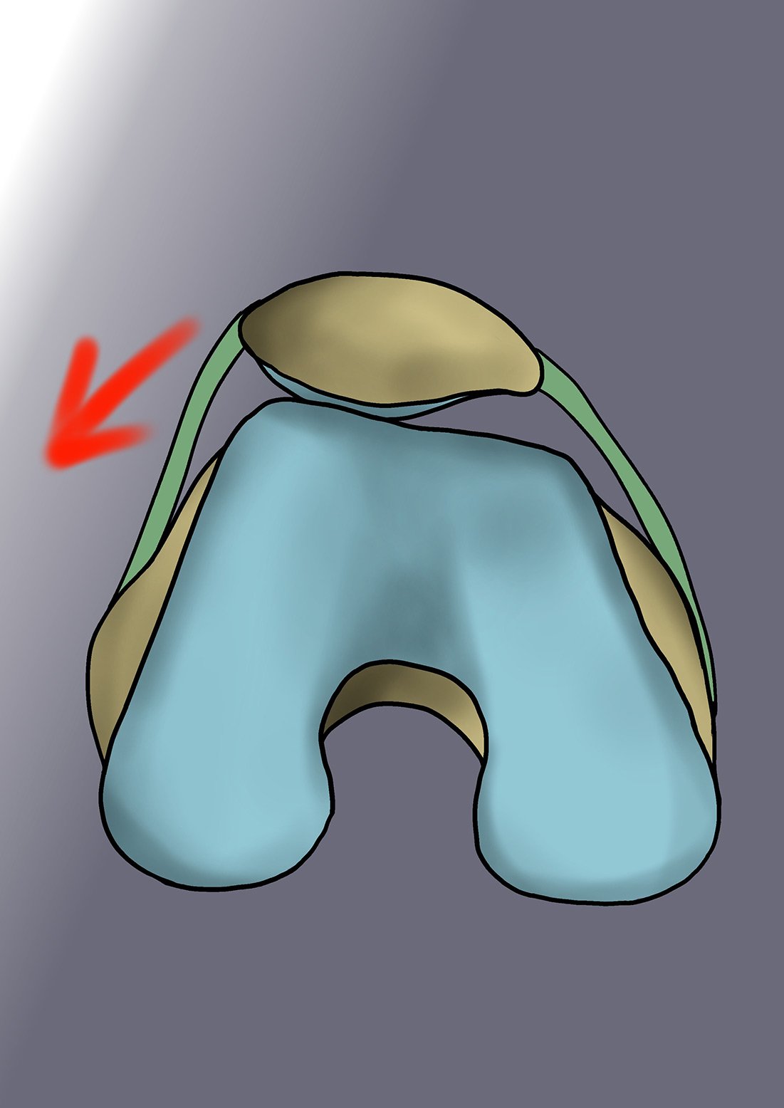 Instabilité Rotulienne du Genou - Clinique à Paris