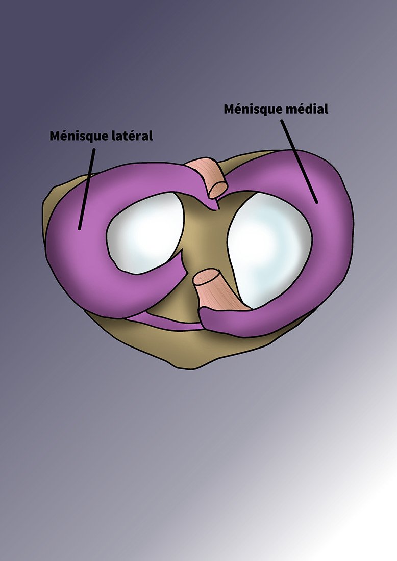 Pathologie Méniscale du Genou | Clinique à Paris