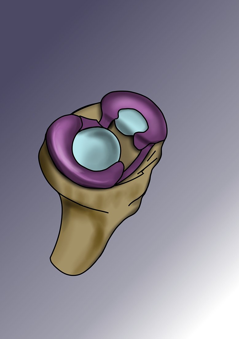 Pathologie Méniscale du Genou | Clinique à Paris