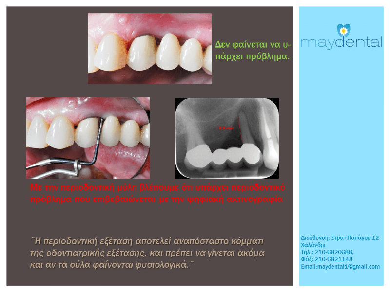 Περιοδοντολογία, Χαλάνδρι | Οδοντιατρική Κλινική, Maydental